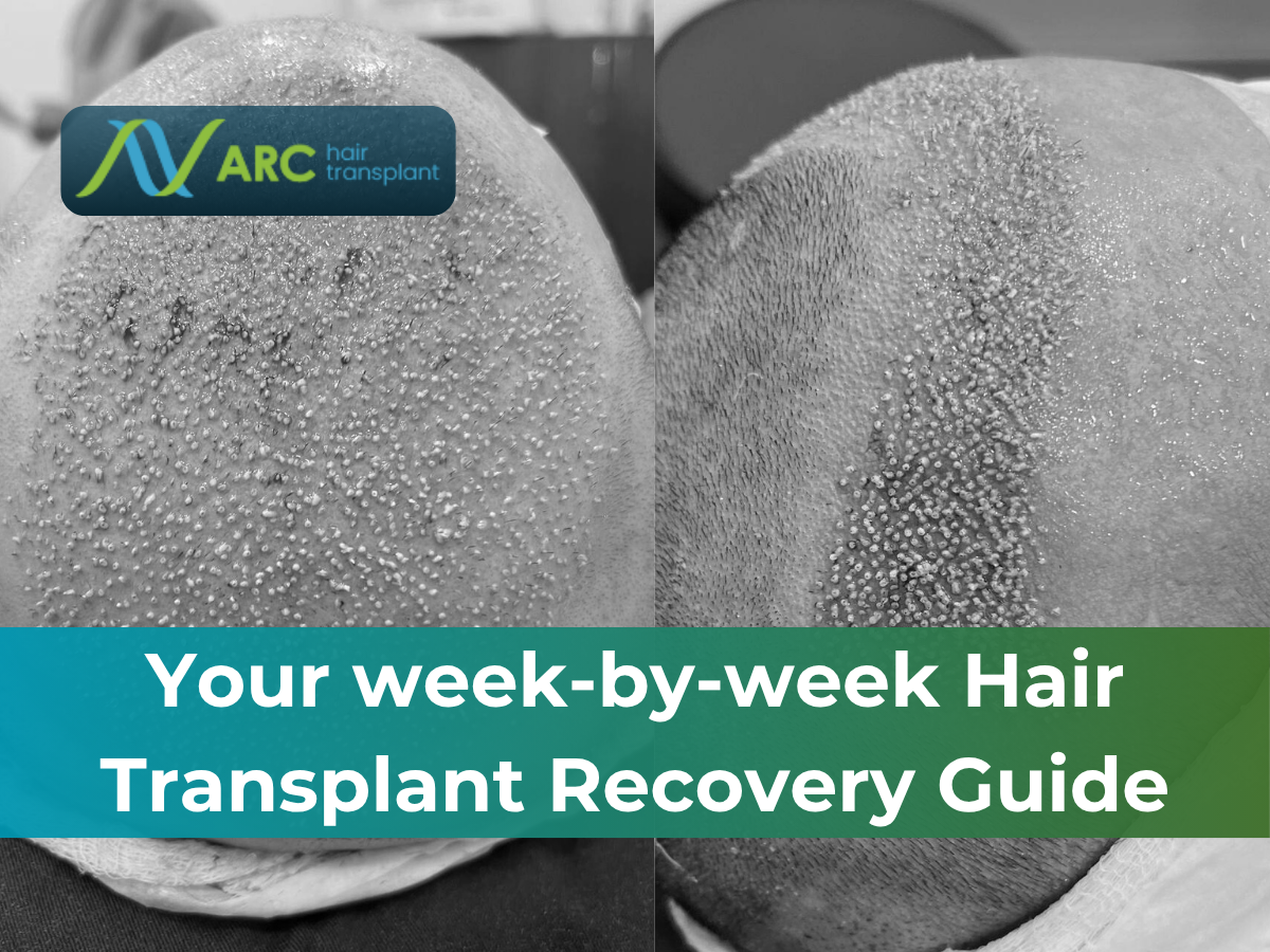 Your Week-by-Week Hair Transplant Recovery Guide - ARC Hair Transplant